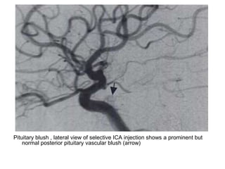 Interventional Neuroradiology: Anatomy of the internal carotid artery ...