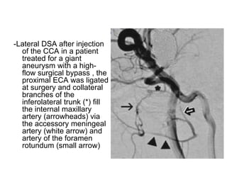 Interventional Neuroradiology: Anatomy of the internal carotid artery ...