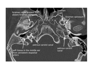 Carotid Petrous Sinus Ct