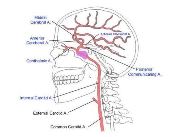 Interventional Neuroradiology: Anatomy of the internal carotid artery (ICA)