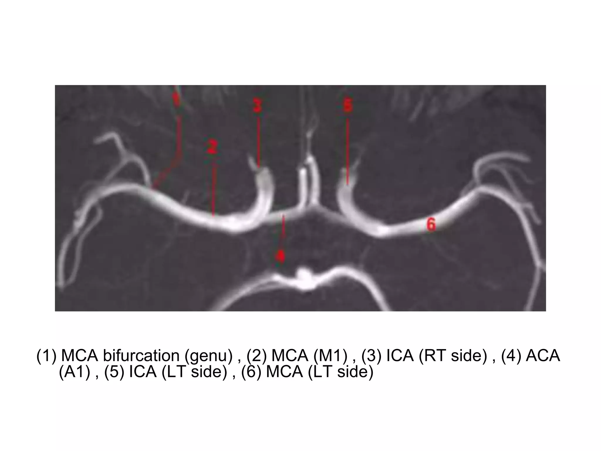 Anatomy of the middle cerebral artery (MCA) | PPT