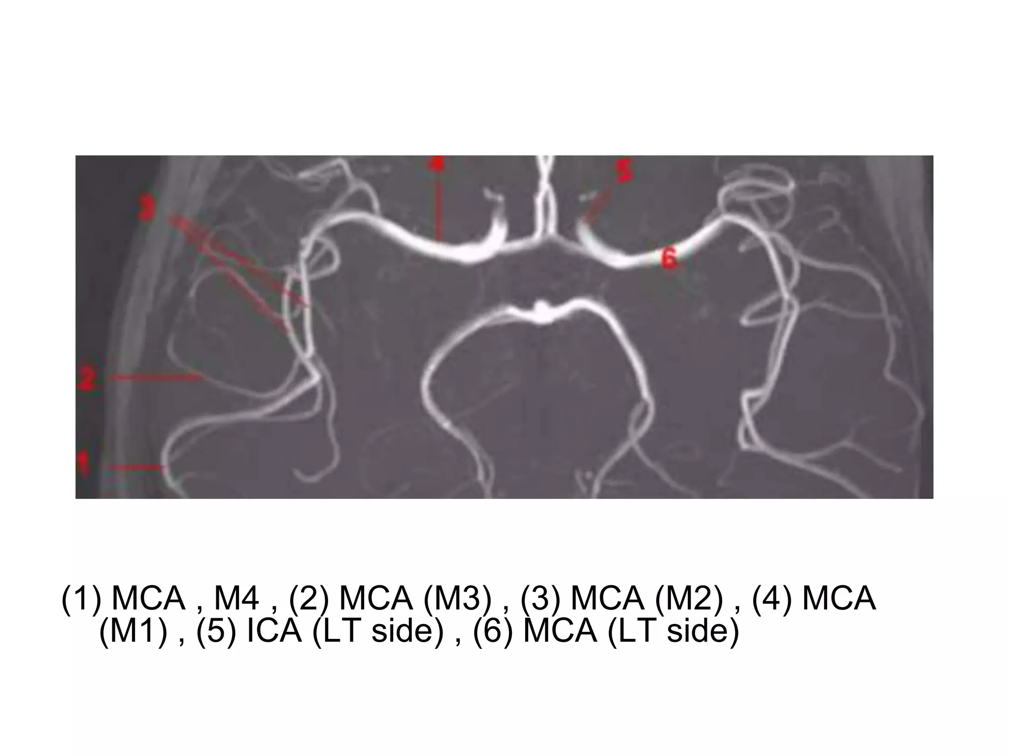 Anatomy of the middle cerebral artery (MCA) | PPT