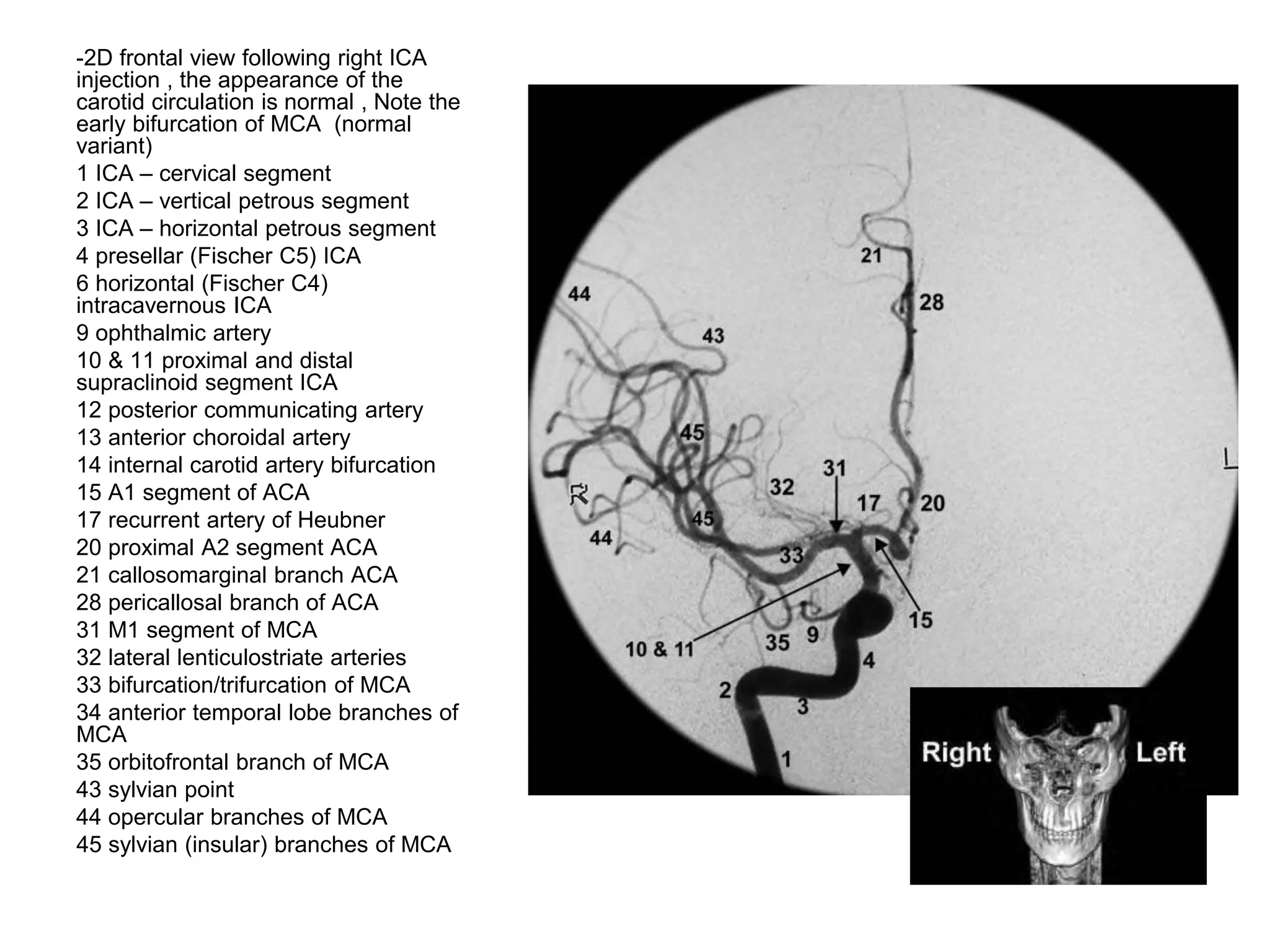 Anatomy of the middle cerebral artery (MCA) | PPT