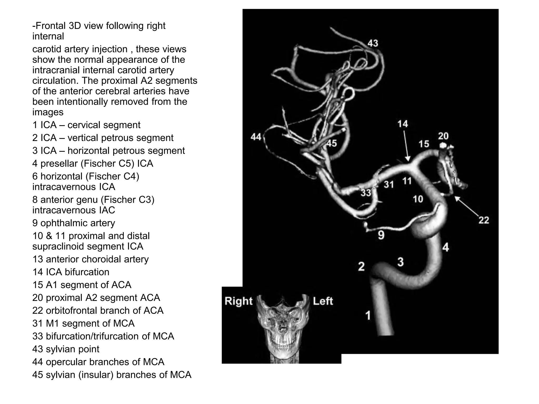 Anatomy of the middle cerebral artery (MCA) | PPT