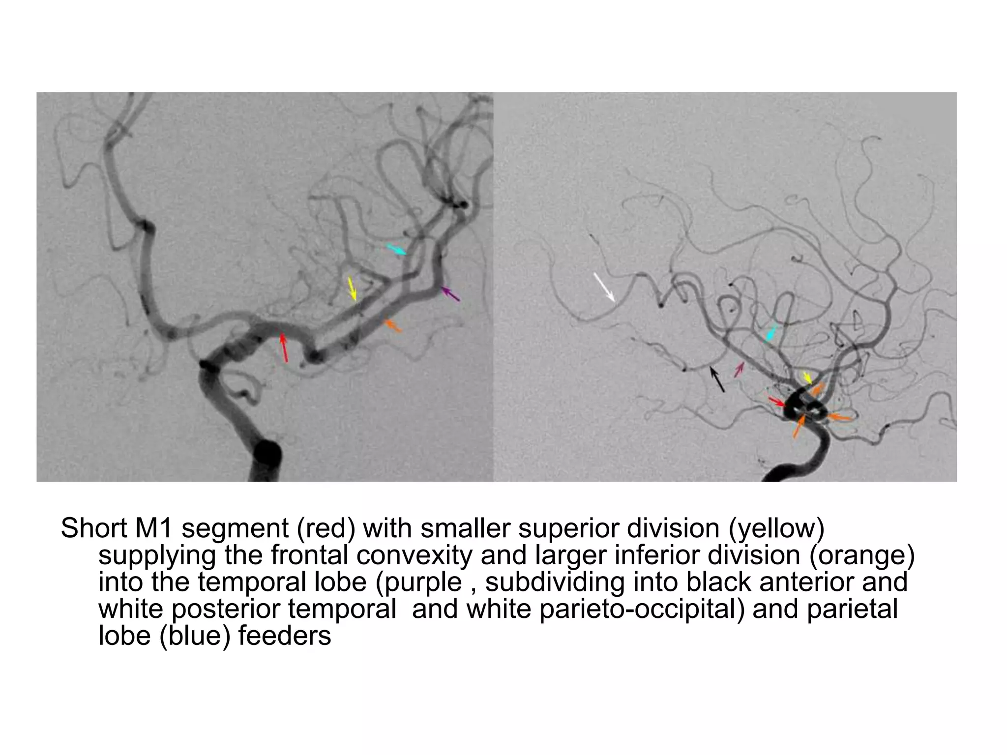 Anatomy of the middle cerebral artery (MCA) | PPT