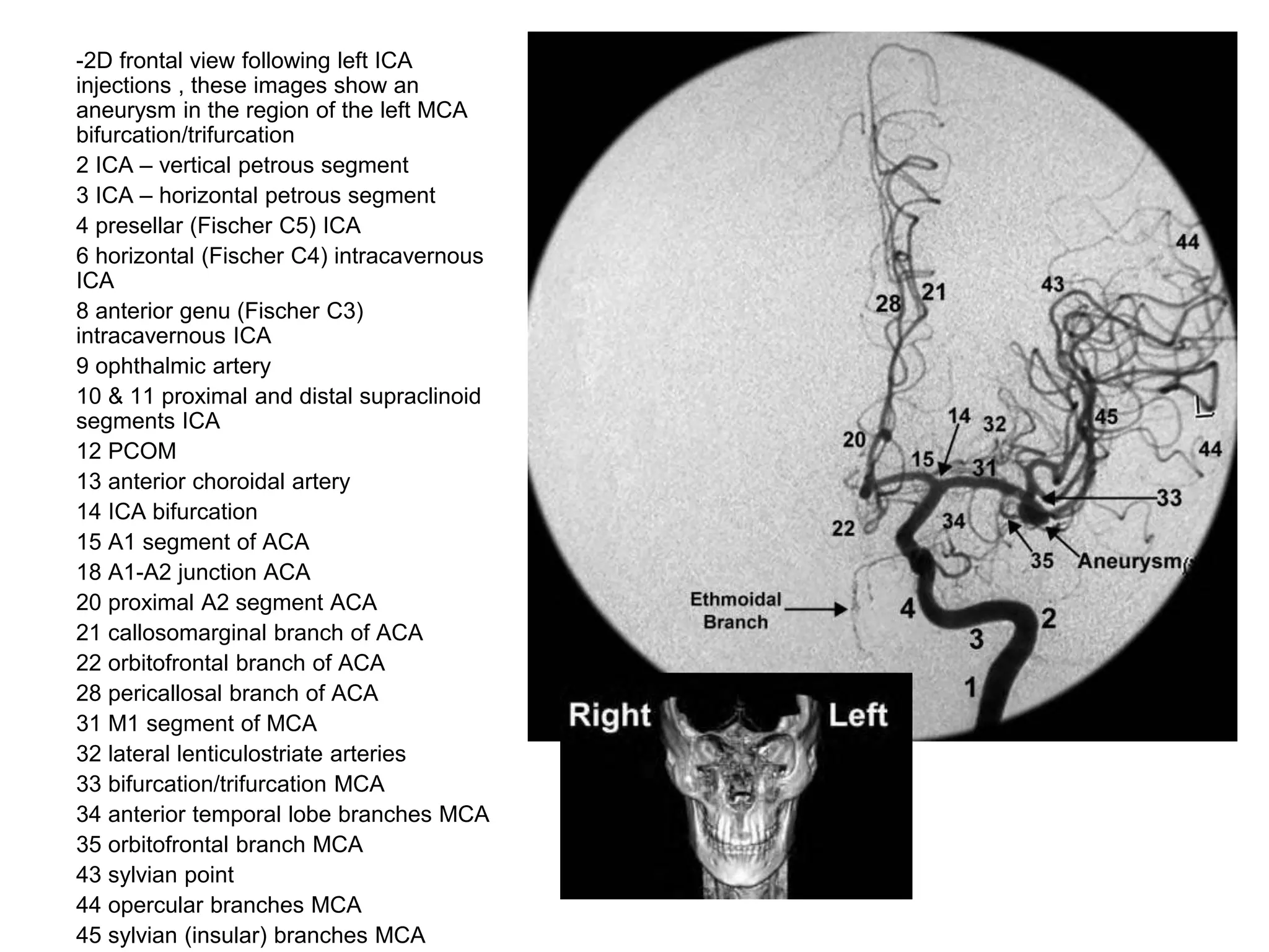 Anatomy of the middle cerebral artery (MCA) | PPT