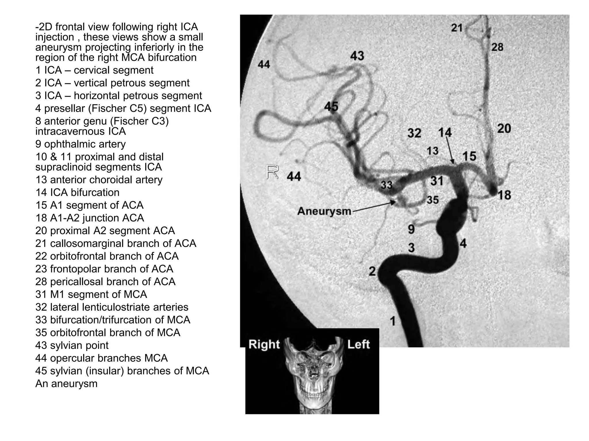 Anatomy of the middle cerebral artery (MCA) | PPT