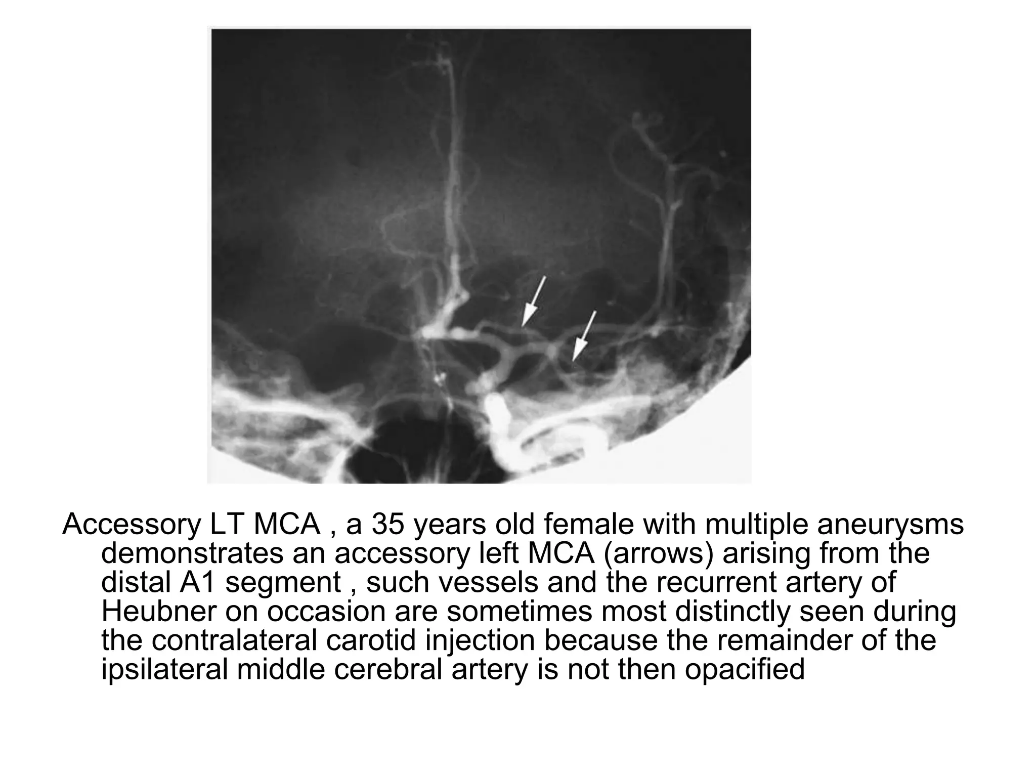 Anatomy of the middle cerebral artery (MCA) | PPT