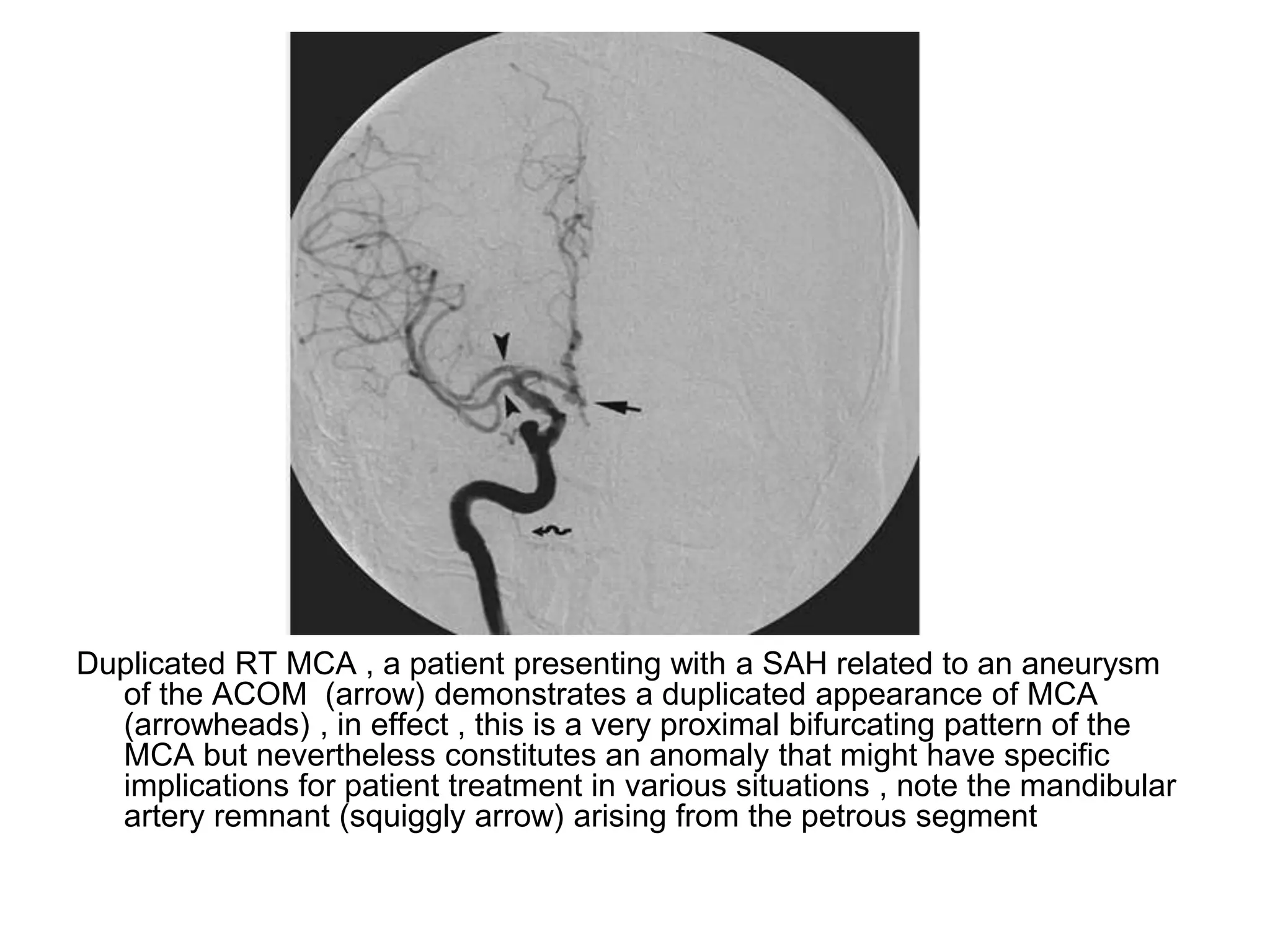 Anatomy of the middle cerebral artery (MCA) | PPT