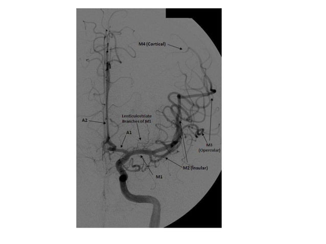 Anatomy of the middle cerebral artery (MCA) | PPT