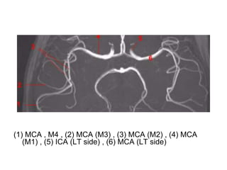 Anatomy of the middle cerebral artery (MCA) | PPT