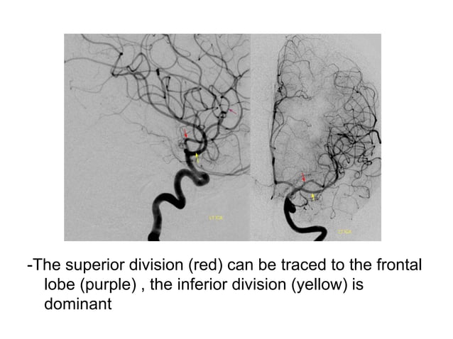 Anatomy of the middle cerebral artery (MCA) | PPT