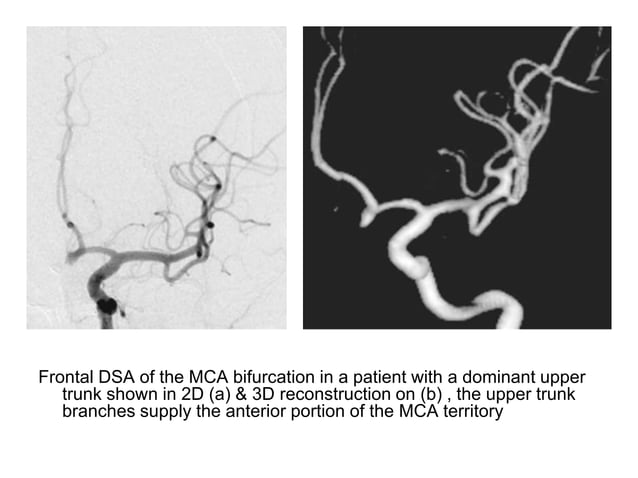 Anatomy of the middle cerebral artery (MCA) | PPT