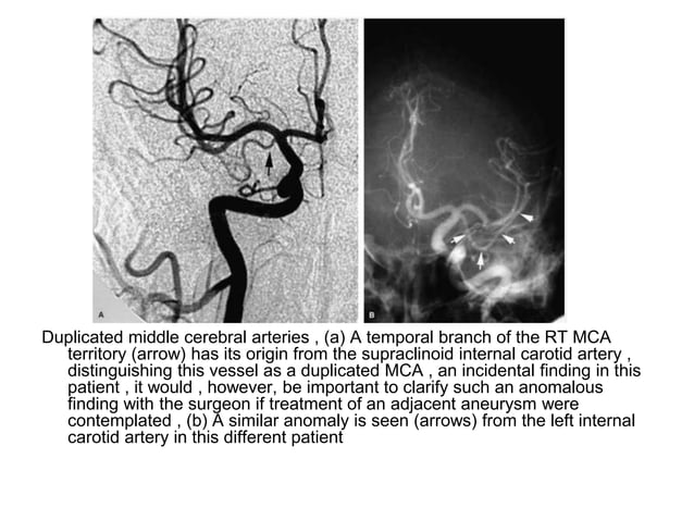 Anatomy of the middle cerebral artery (MCA) | PPT
