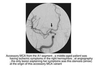 Anatomy of the middle cerebral artery (MCA) | PPT