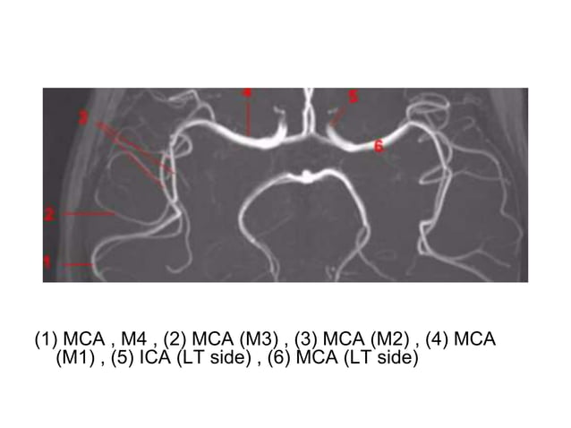 Anatomy of the middle cerebral artery (MCA)
