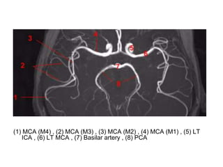 Anatomy of the middle cerebral artery (MCA) | PPT