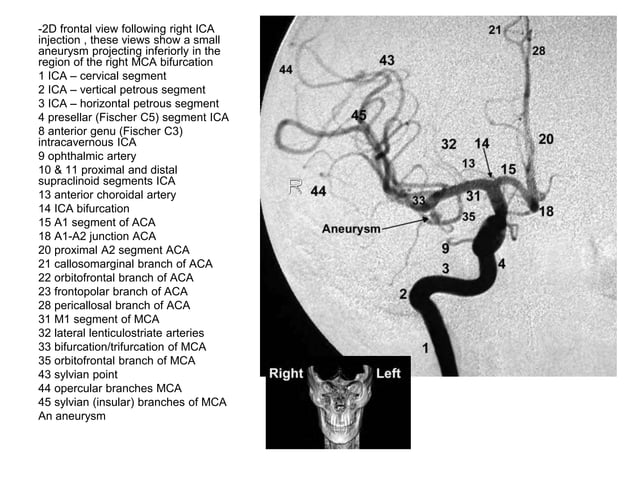 Anatomy of the middle cerebral artery (MCA)