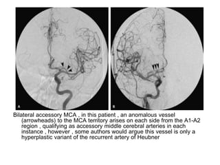 Middle Cerebral Artery Angiogram