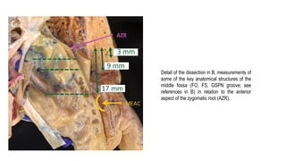 Anatomy Middle Cranial Fossa Kelvin.pptx