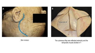 Anatomy Middle Cranial Fossa Kelvin.pptx