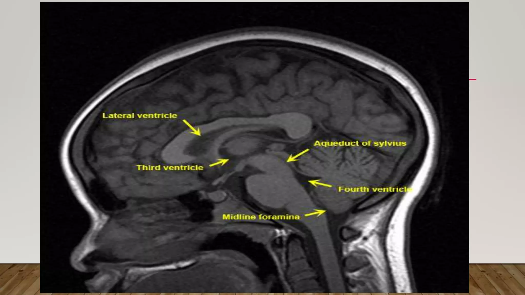 Anatomy of 4th ventricle | PPTX