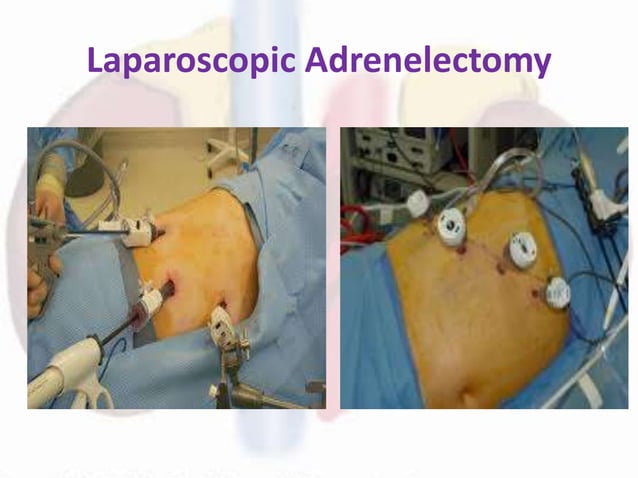 Surgical Anatomy of adrenal gland | PPT