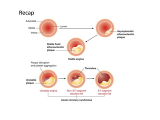 Anatomy of a heart attack | PPT