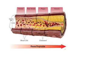 Anatomy of a heart attack | PPT