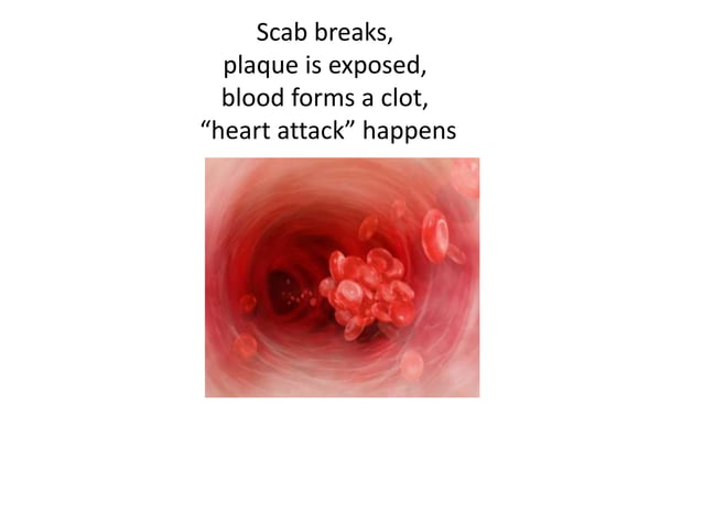 Anatomy of a heart attack | PPT