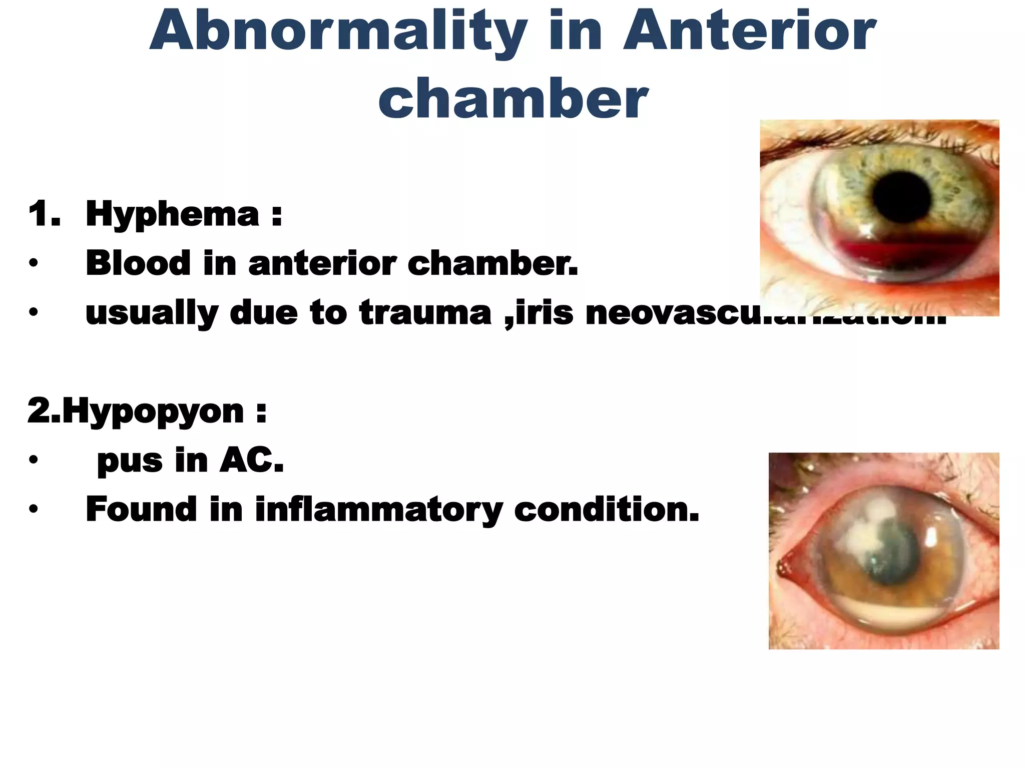 Anatomy of anterior chamber angle (1) | PPTX