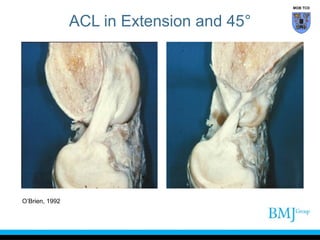 Anatomy of anterior_cruciate_ligament | PPT