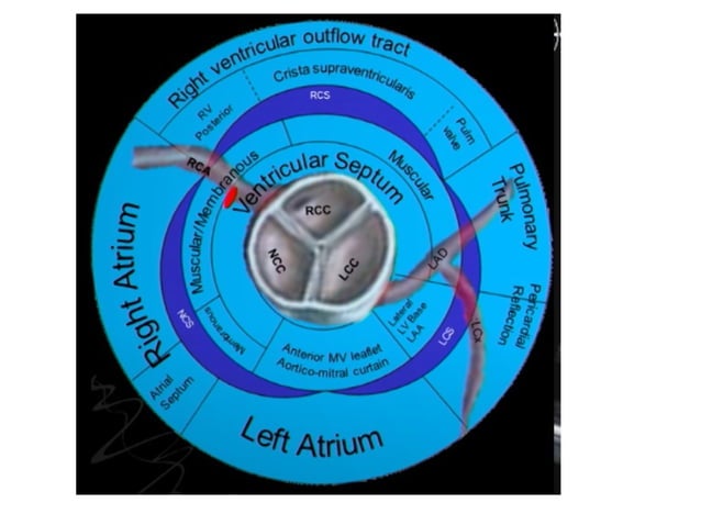 Anatomy Of Aortic Valve- Dr Garv Ameta (1).pptx