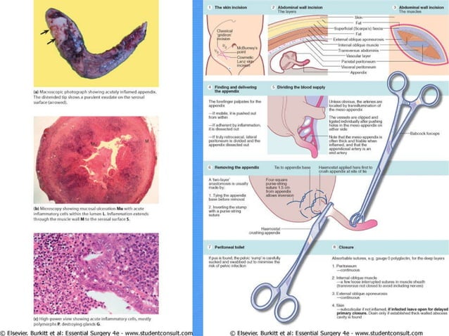 Anatomy of appendix | PPT | Digestive Disorders | Diseases and Conditions