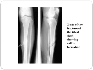 Anatomy of Bone and Fracture Healing.pptx
