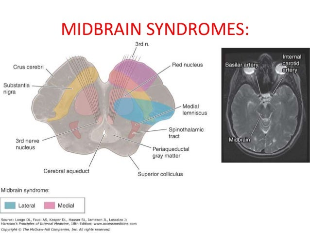 Anatomy of brainstem and its clinical significance