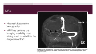Anatomy of cerebral veins | PPTX