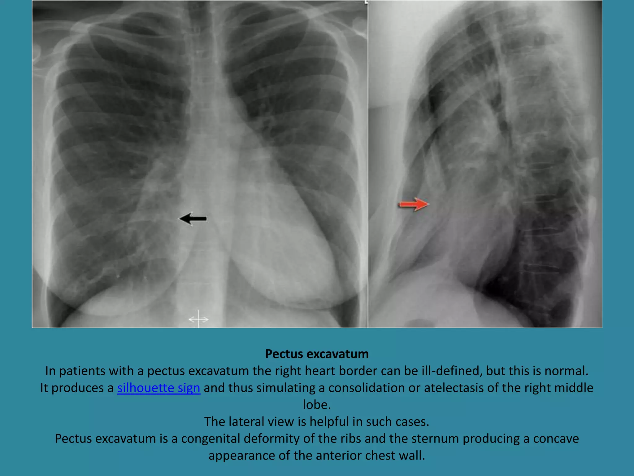 Anatomy of chest | PPTX