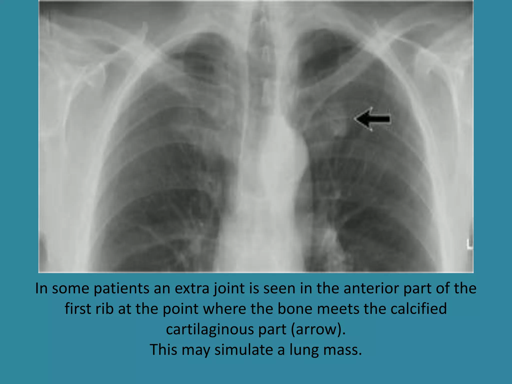 Anatomy of chest | PPTX