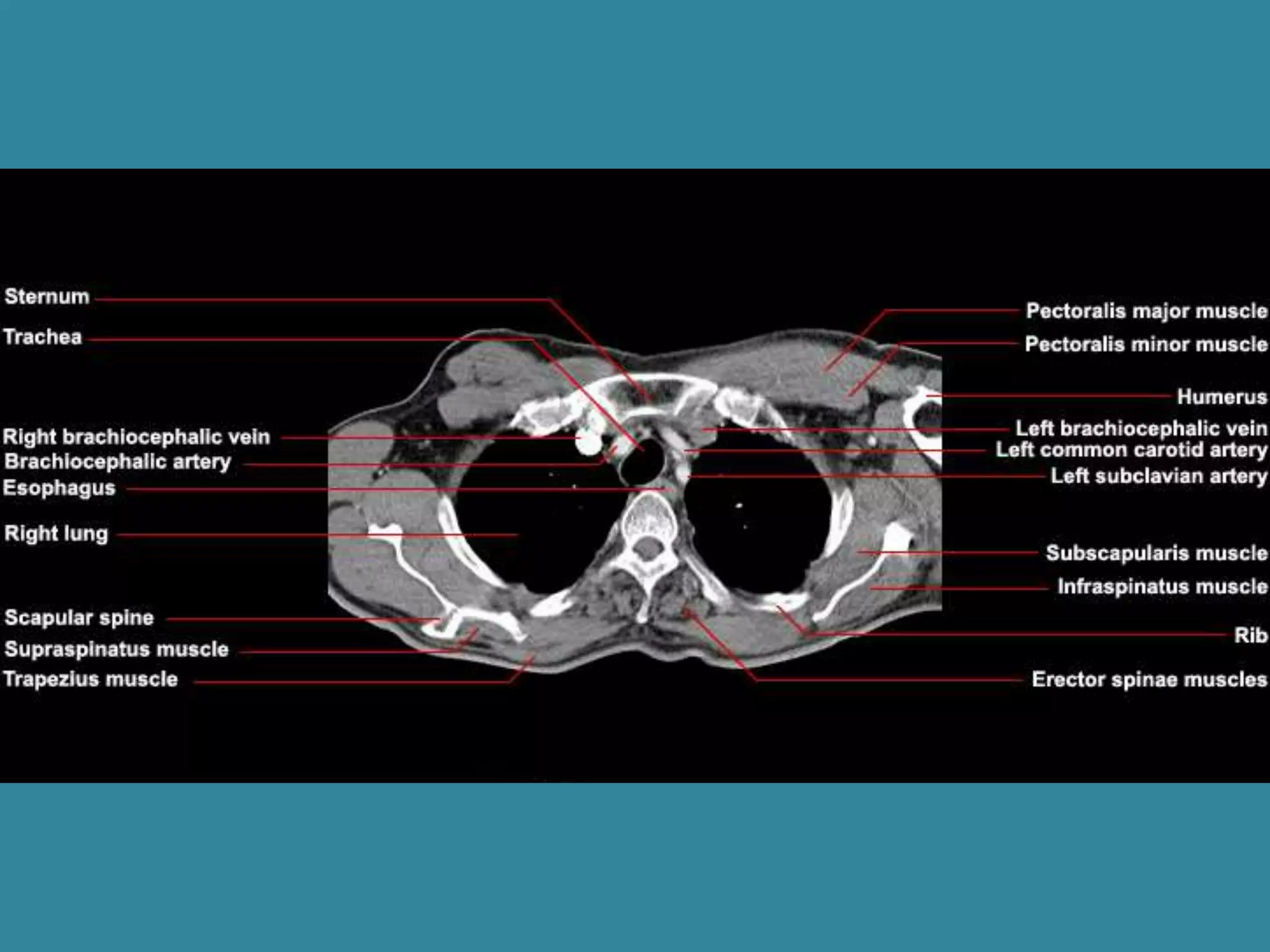 Anatomy of chest | PPTX