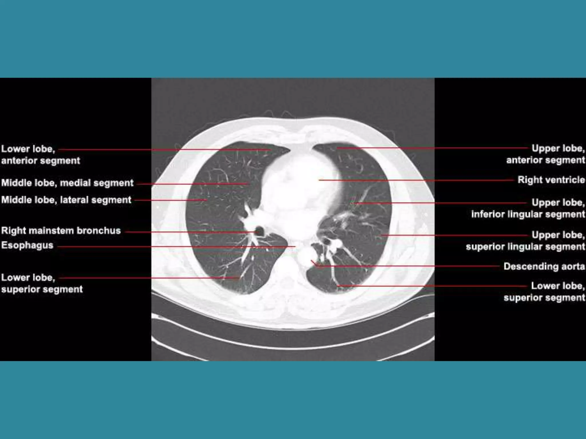 Anatomy of chest | PPTX
