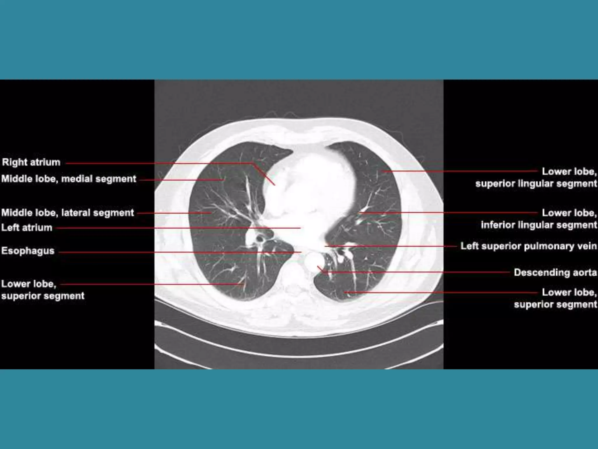Anatomy of chest | PPTX