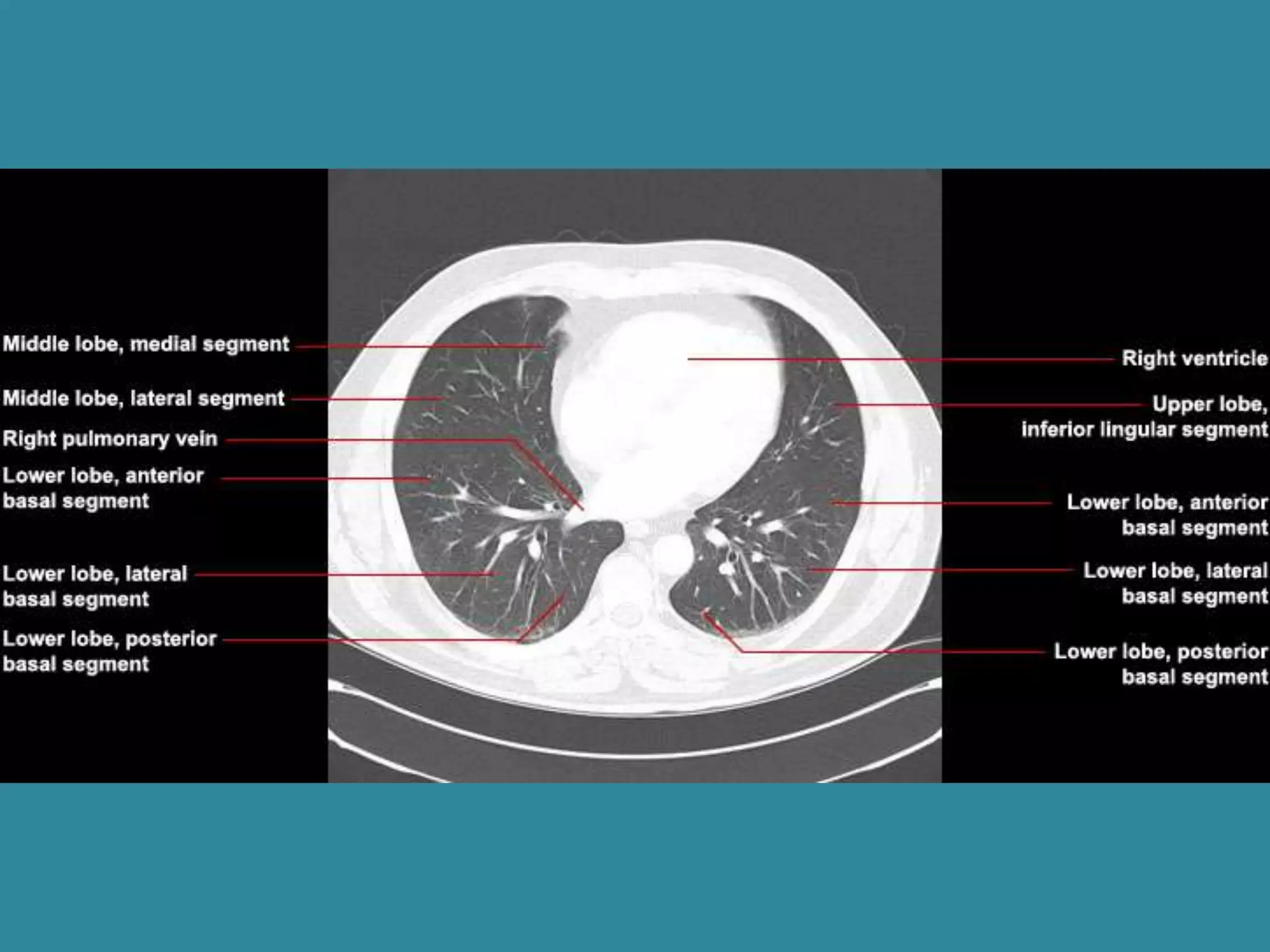 Anatomy of chest | PPTX