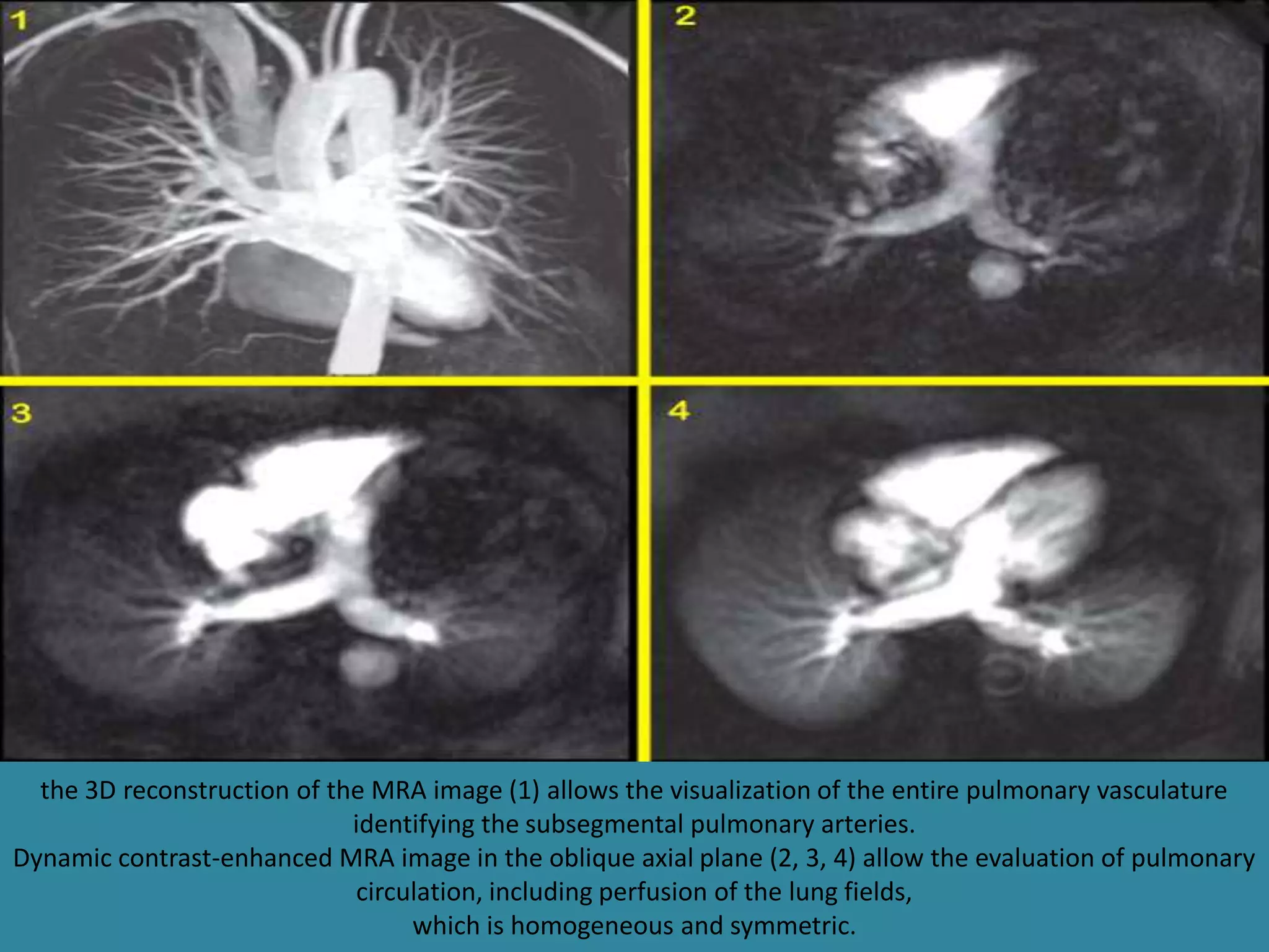 Anatomy of chest | PPTX