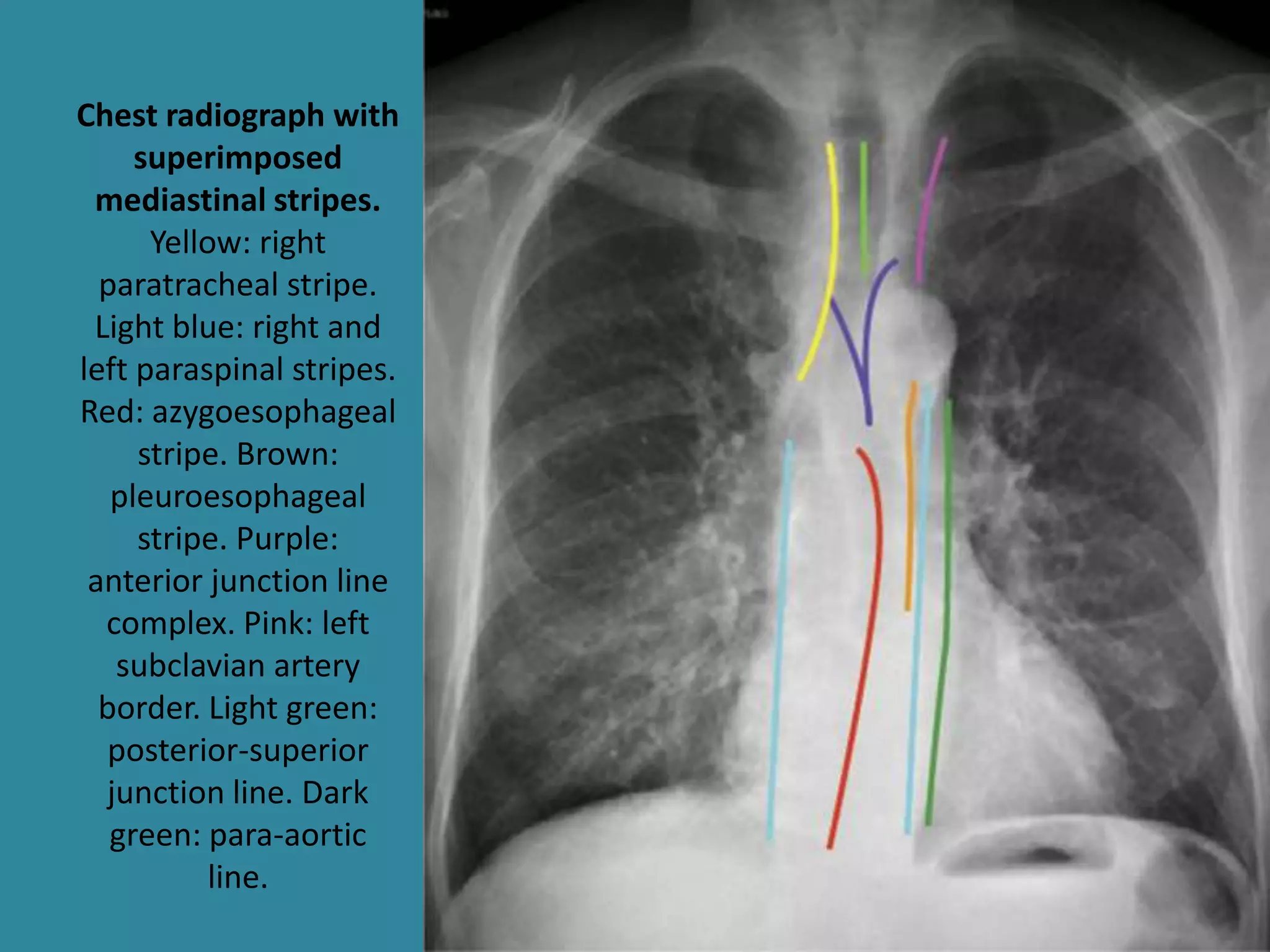 Anatomy of chest | PPTX
