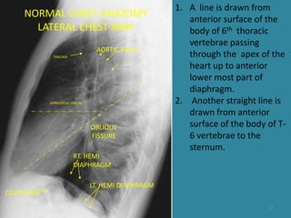 Lateral Cxr Anatomy