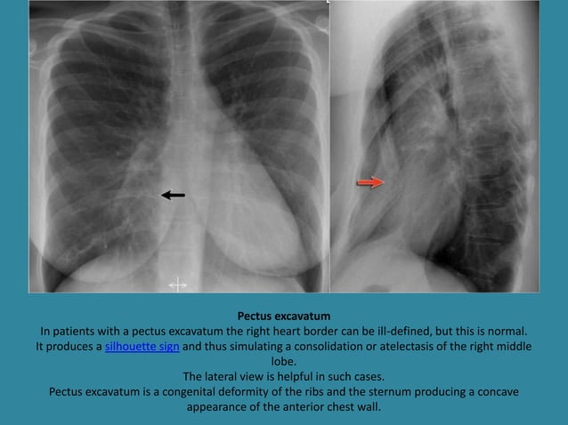 Anatomy of chest | PPTX