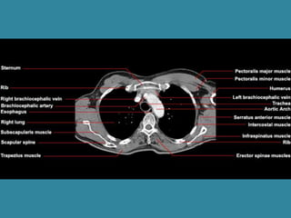 Anatomy of chest | PPTX