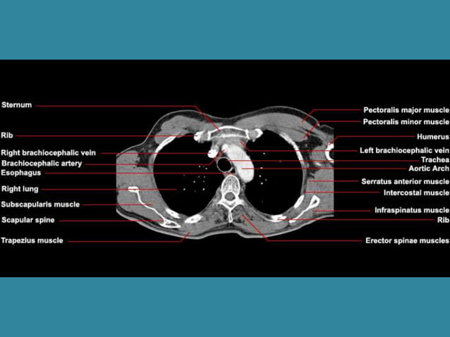Anatomy of chest | PPTX