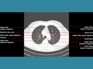Anatomy of chest | PPTX